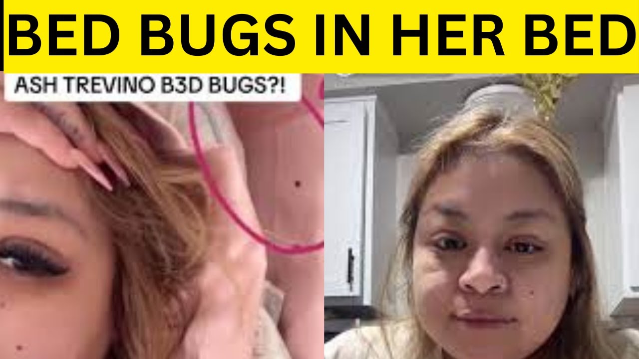 Ash Trevino Has Bed Bugs It Was Seen On Live Youtube