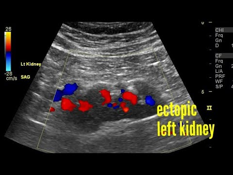 Ectopic Kidney With Malrotation Ultrasound And Color Spectral Doppler