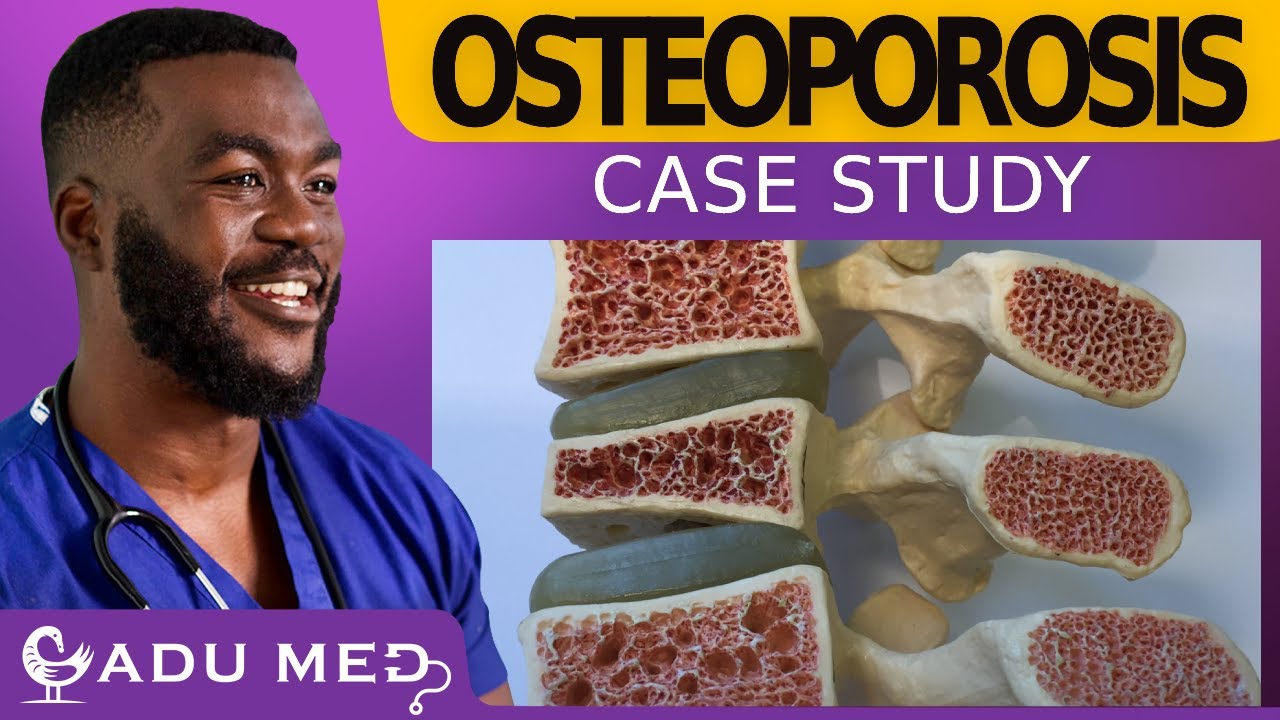 Osteoporosis Case Study Background And Assessment Pass The Mrcgp Akt