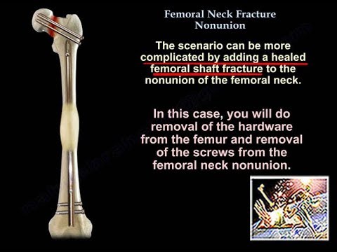 Femoral Neck Fracture Nonunion Everything You Need To Know Dr