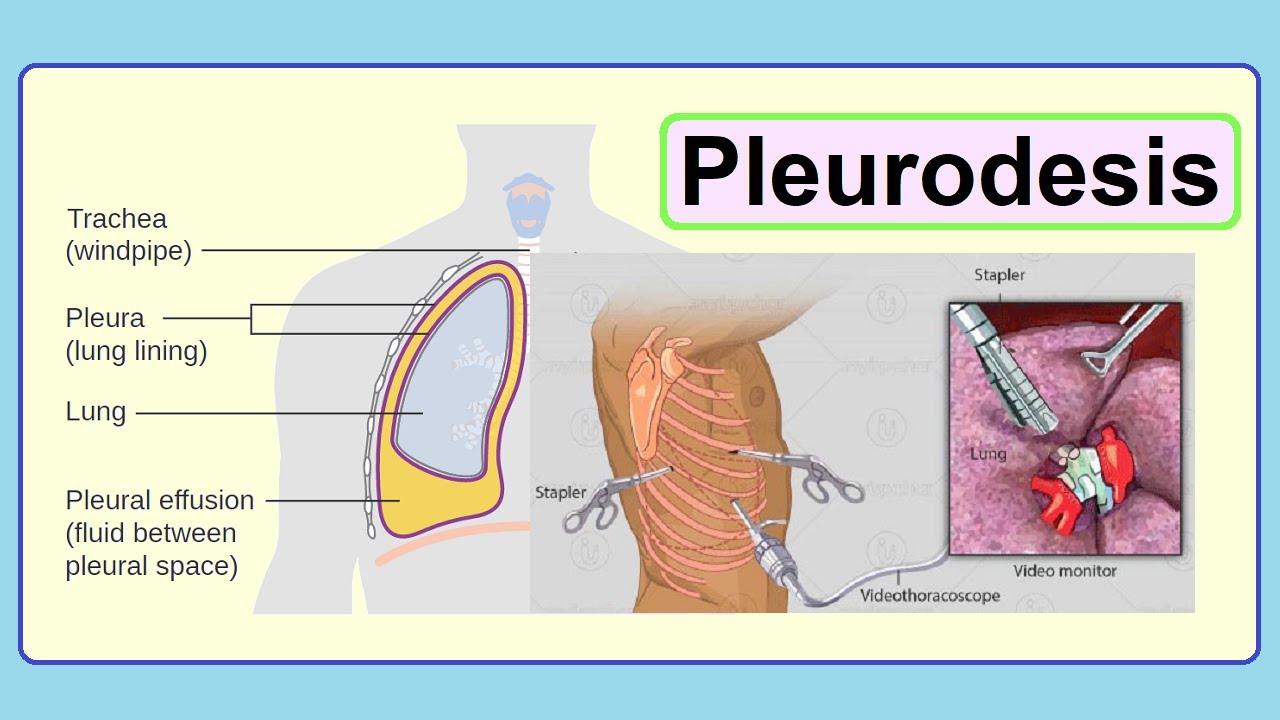 Pleurodesis Youtube