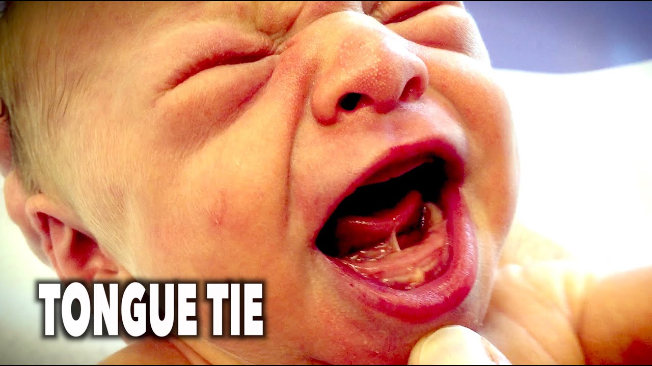 Tongue Tie Surgery Much More Dr Paul Youtube