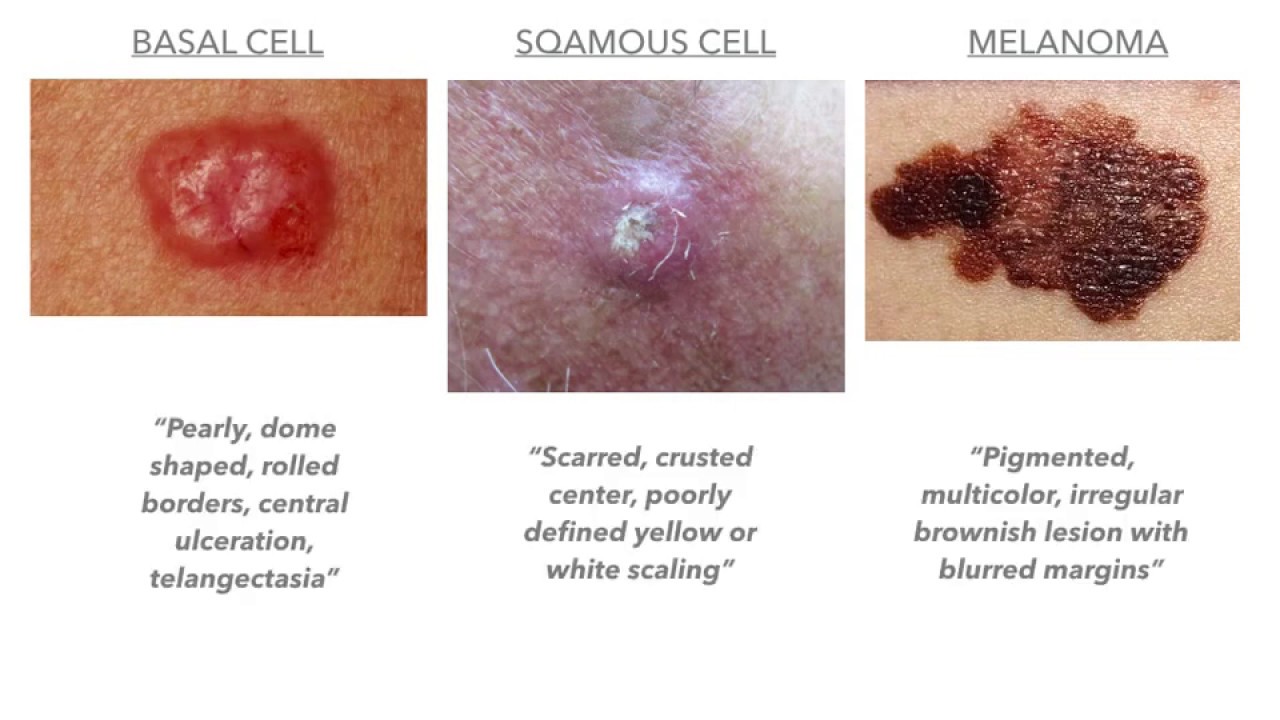 Basal Cell Carcinoma Vs Squamous Cell Carcinoma Usmle