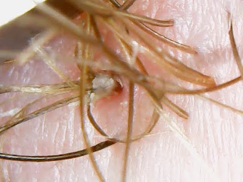 41 Massive Pili Multigemini With Inverted Pore Tube Youtube
