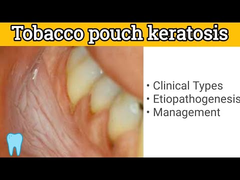 Tobacco Pouch Keratosis Snuff Dipper Lesion Clinical Features