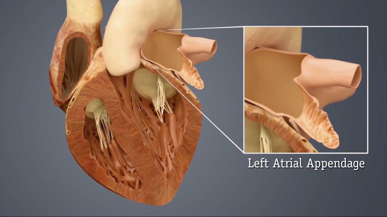 Watchman Left Atrial Appendage Penn State Heart And Vascular