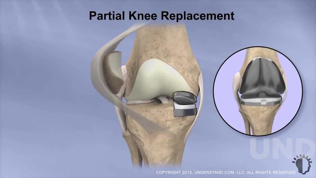 Partial Knee Replacement Scar