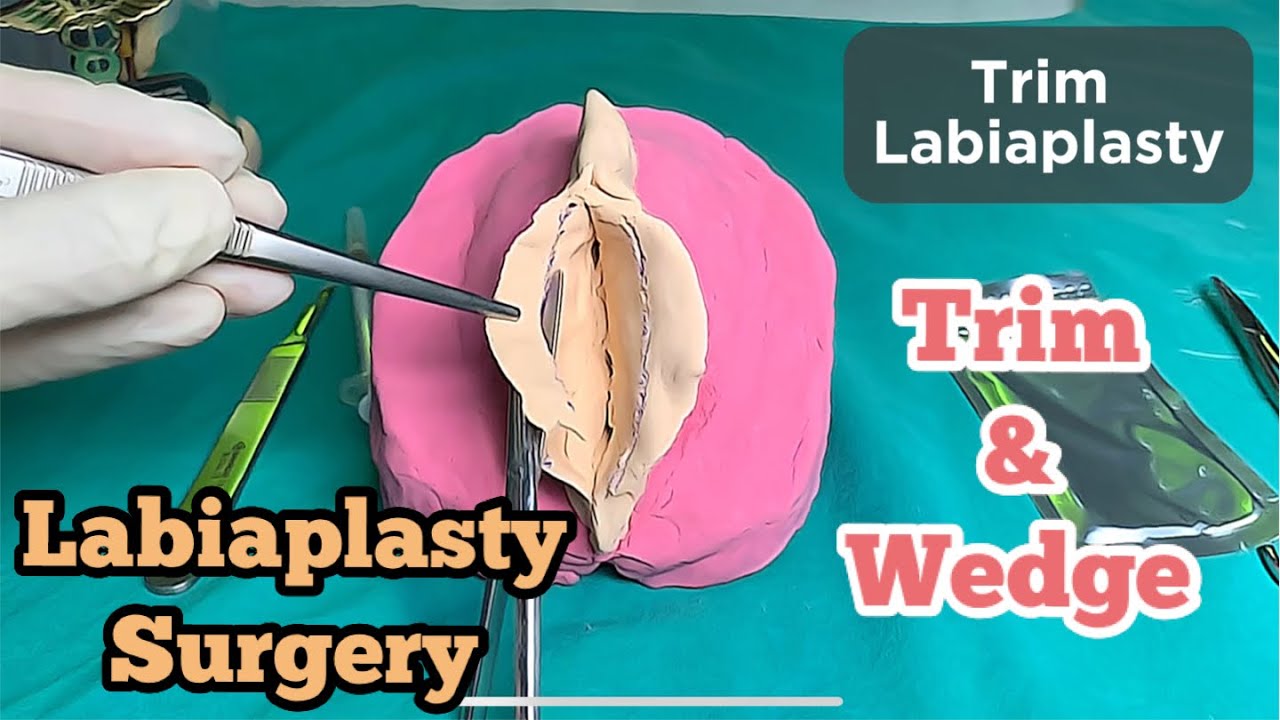 Labiaplasty Pictures Before And After Wiyoi