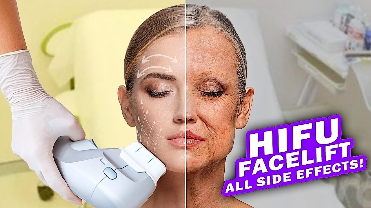 Hifu Facelift Does It Really Work Youtube