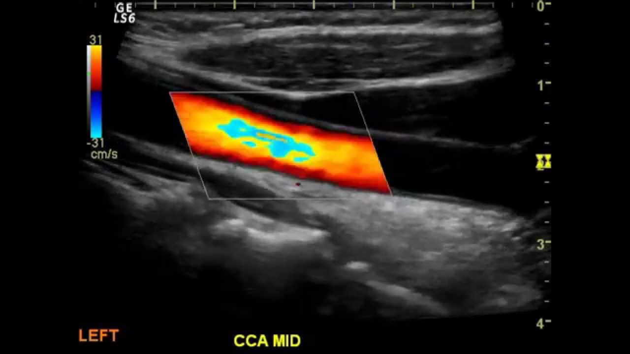 Normal Carotid Duplex Youtube