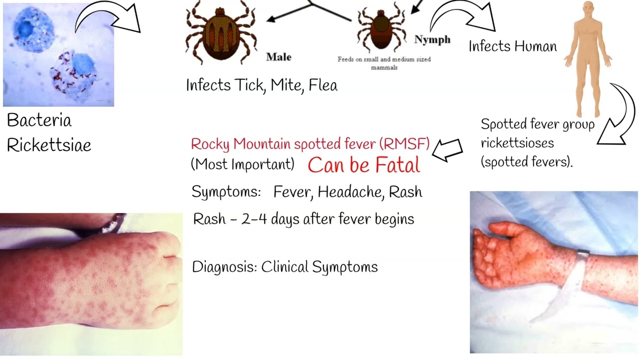 Rocky Mountain Spotted Fever