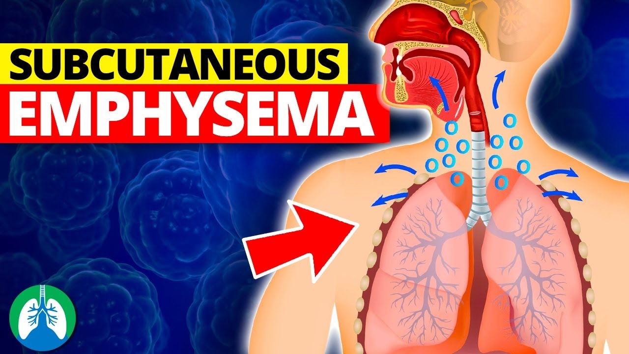 Subcutaneous Emphysema Medical Definition Quick Explainer Video