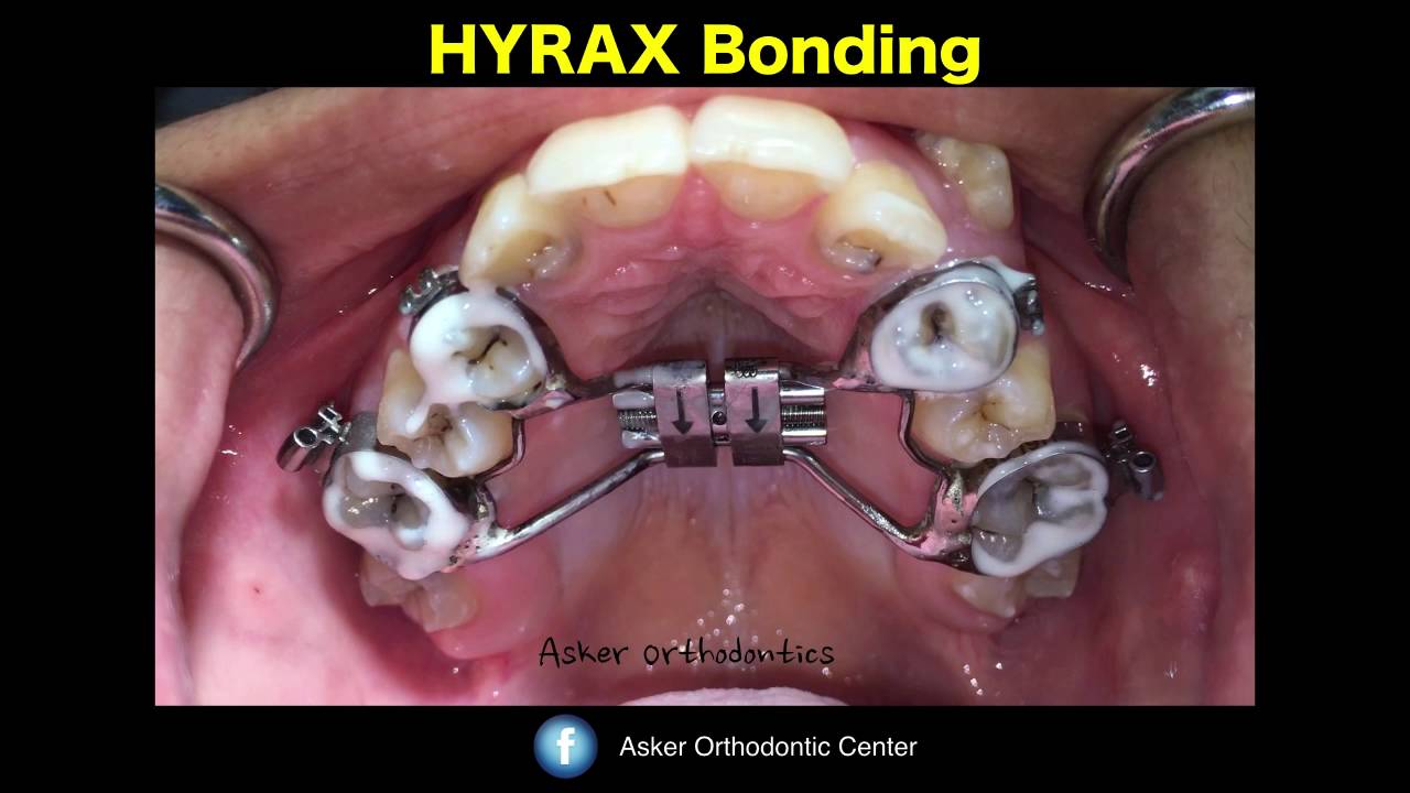 Bonding Hyrax Expander In Orthodontics Maxilla Expansion Orthodontic