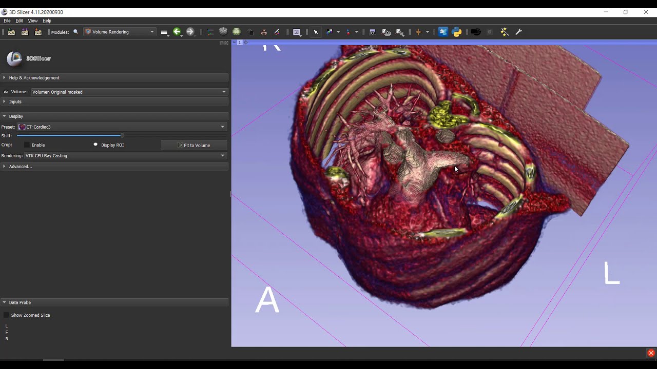 3d Slicer Using A Segment Surface To Hollow A Volume Render Youtube