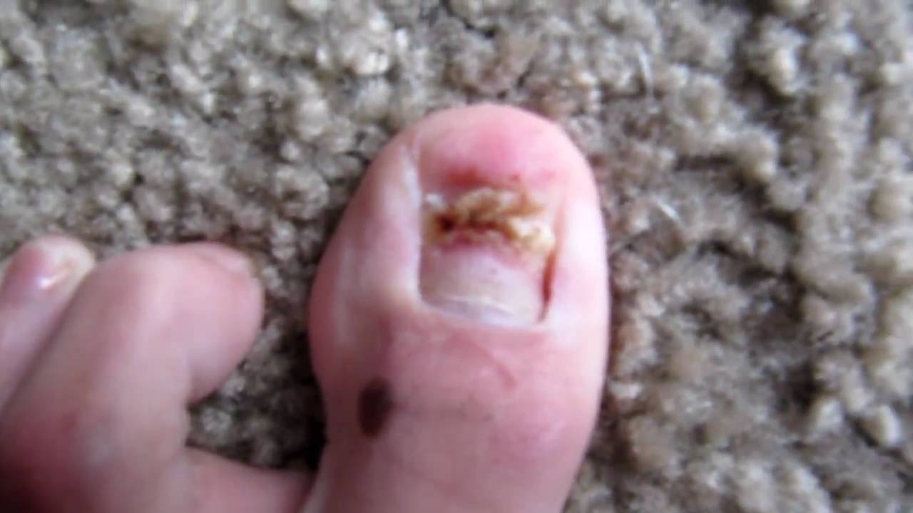My Toenail Fell Off Today Youtube