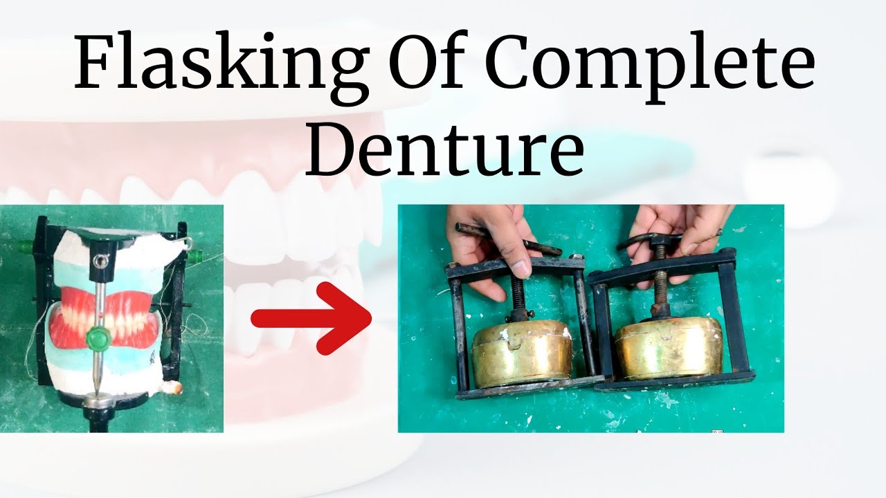 Flasking Of Complete Denture Youtube