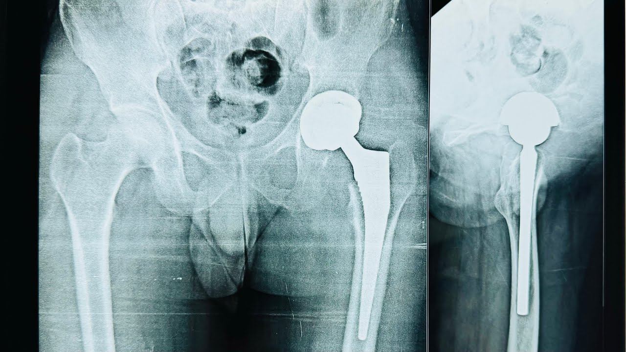 Drabhishekshinde Hipreplacementsurgery Jointreplacement