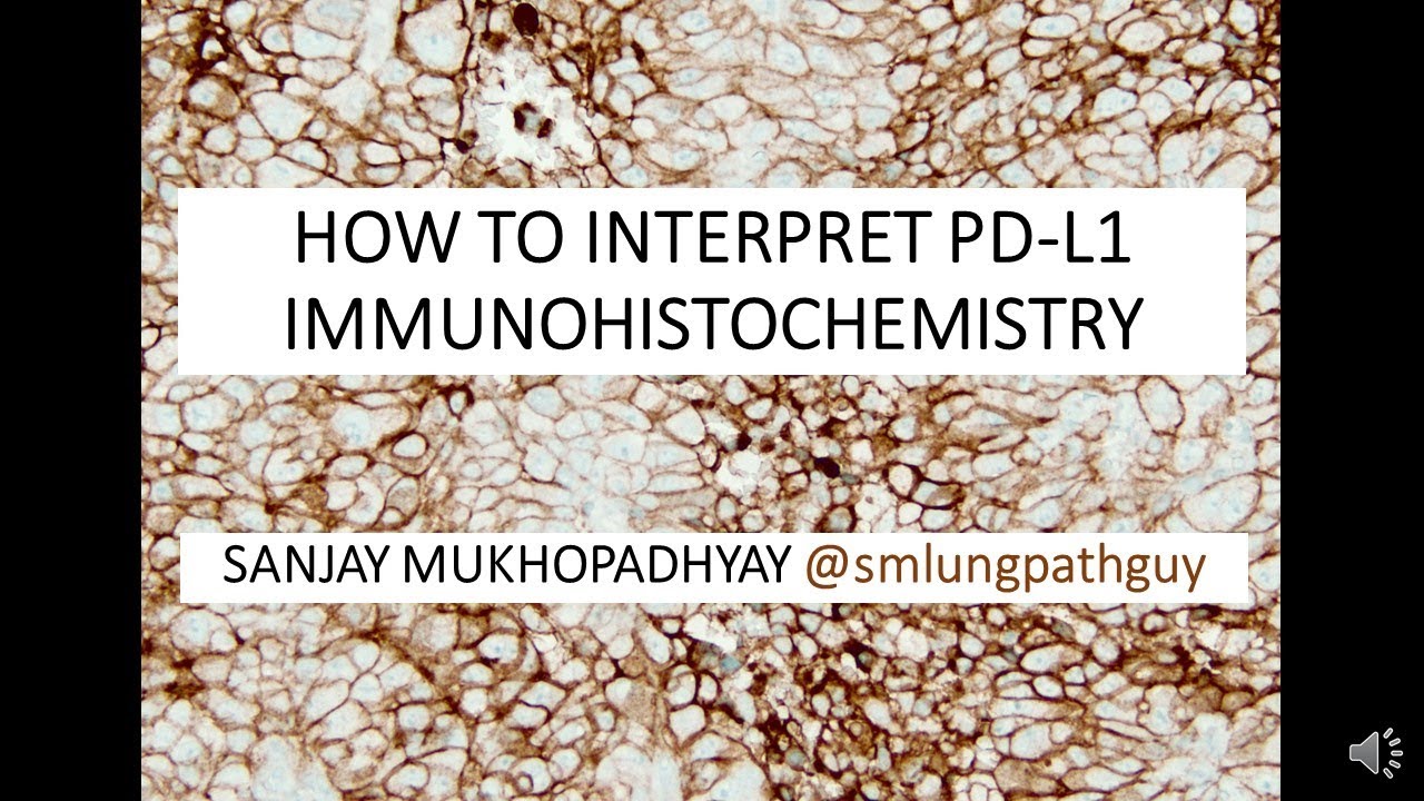 How To Interpret A Pd L1 Immunostain Youtube