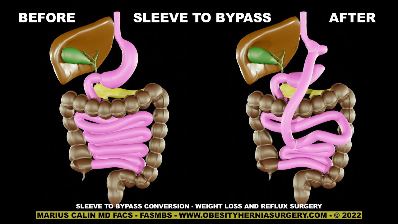 Sleeve To Bypass Revision For Reflux At Anthony Tryon Blog