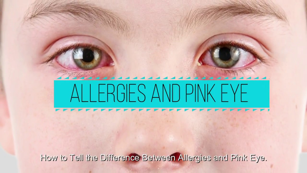 How To Tell The Difference Between Allergies And Pink Eye Youtube