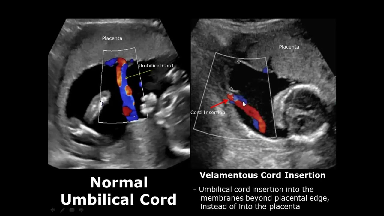 Cord Insertion Ultrasound At Genevieve Tarrant Blog