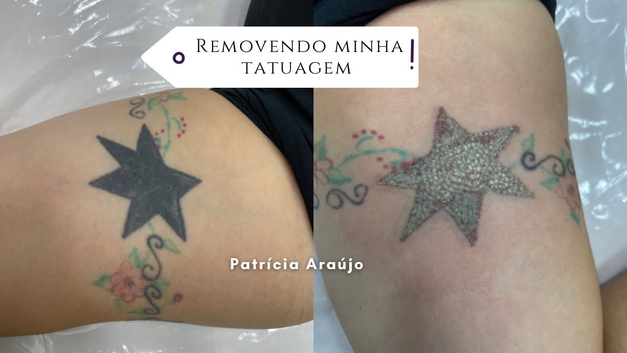 Removendo Uma Tatuagem Que Me Arrependi De Ter Feito Youtube
