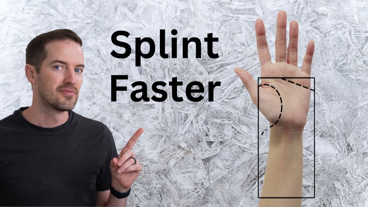 How To Splint Faster In Hand Therapy Youtube