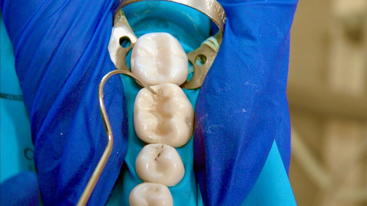 Composite Resin Restoration At Matthew Mcguirk Blog