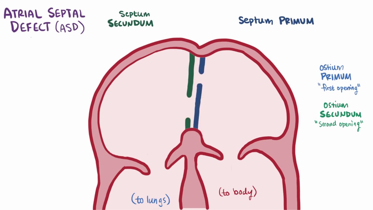 Types Of Atrial Septal Defect Asd Download Scientific Vrogue Co