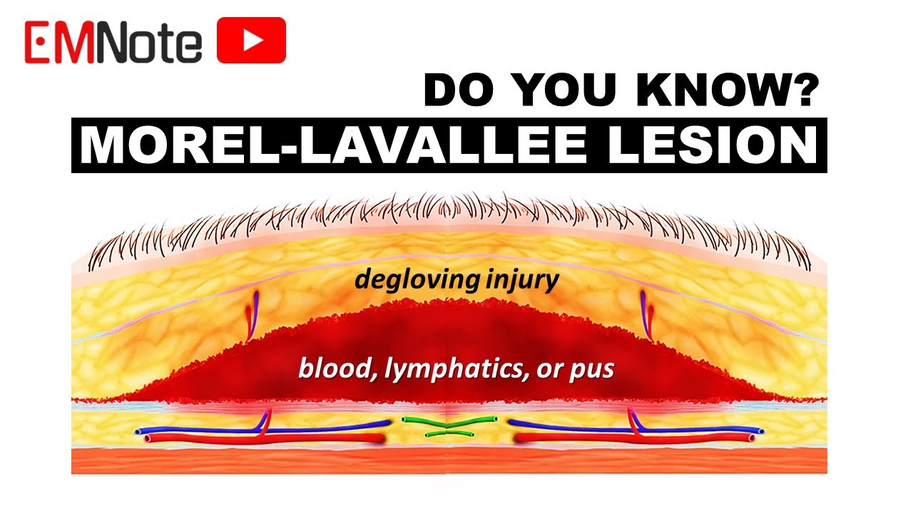 Morel Lavallee Lesion Pathology At John Richard Blog