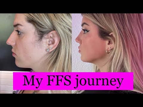My Ffs Journey Youtube
