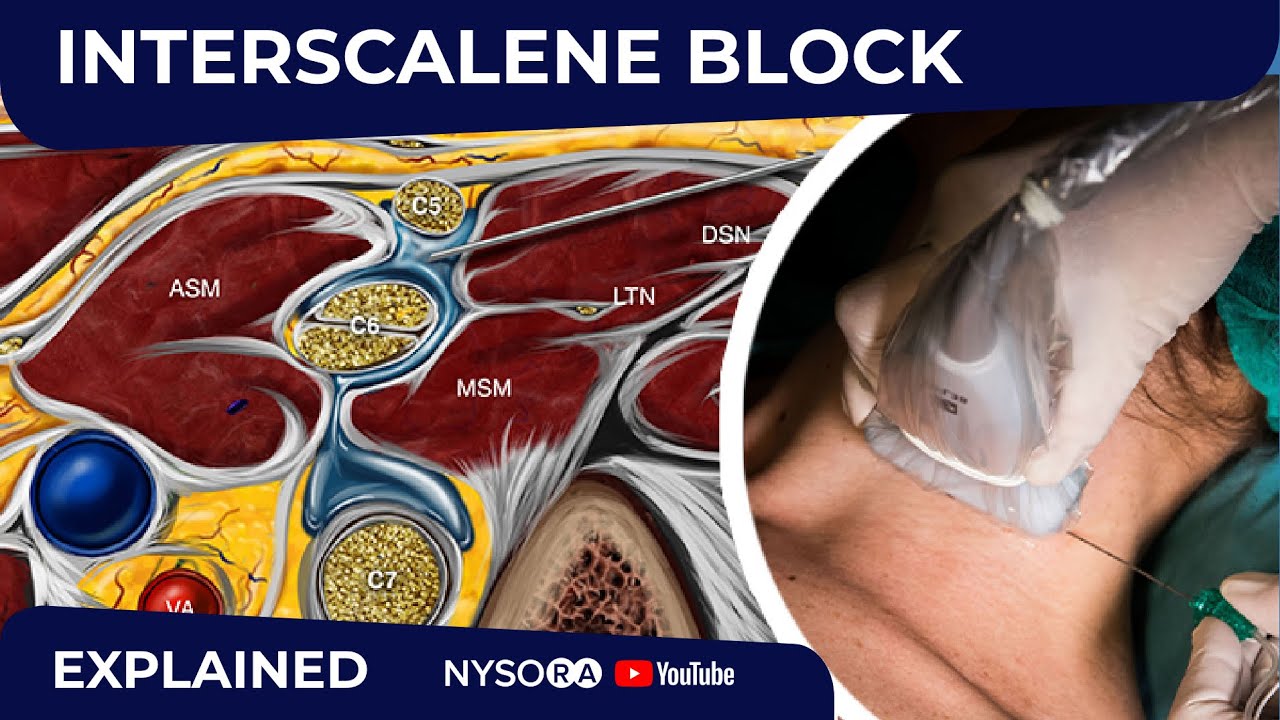 Interscalene Block