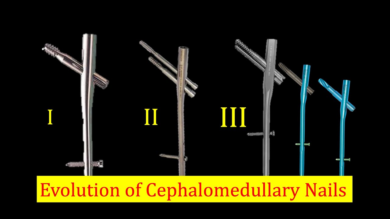 Evolution Of Cephalomedullary Nails Pfn Youtube
