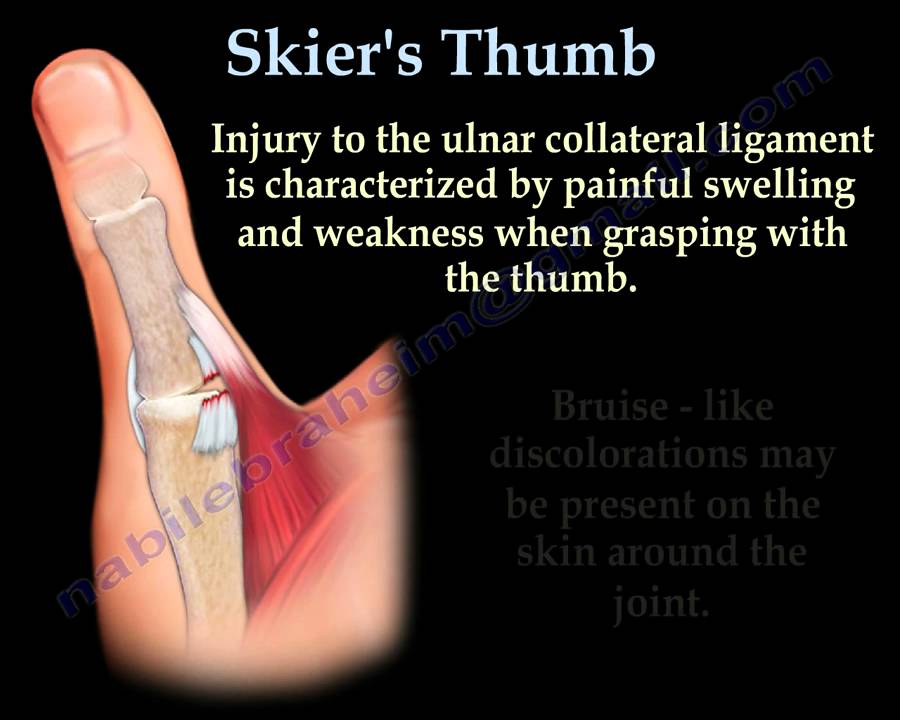 Skier S Thumb Gamekeeper S Thumb Everything You Need To Know Dr