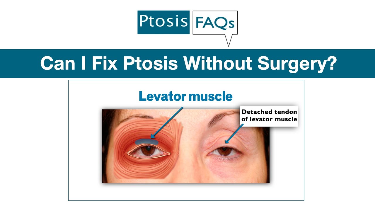 Droopy Eyelid Fix Without Surgery Infoupdate Org