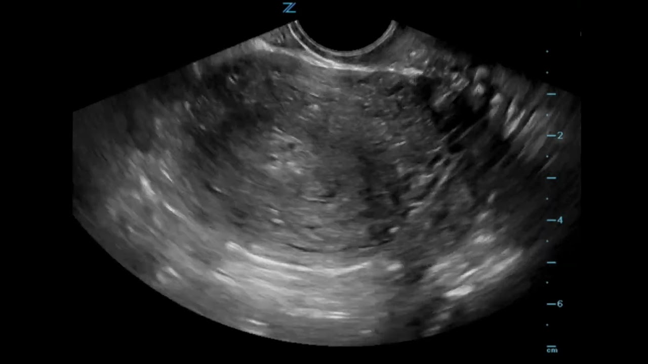 Early Pregnancy Ultrasound Early Pregnancy Scan Southampton