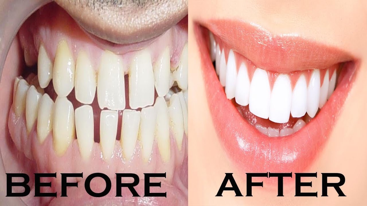 How To Fill The Gaps Between The Teeths Solution Youtube