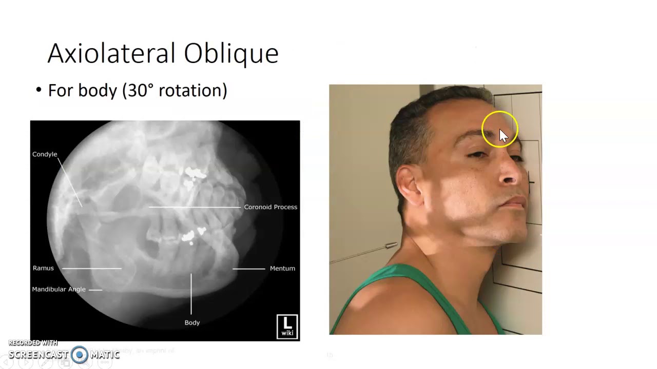 Mandible Tmj X Ray Lab Youtube