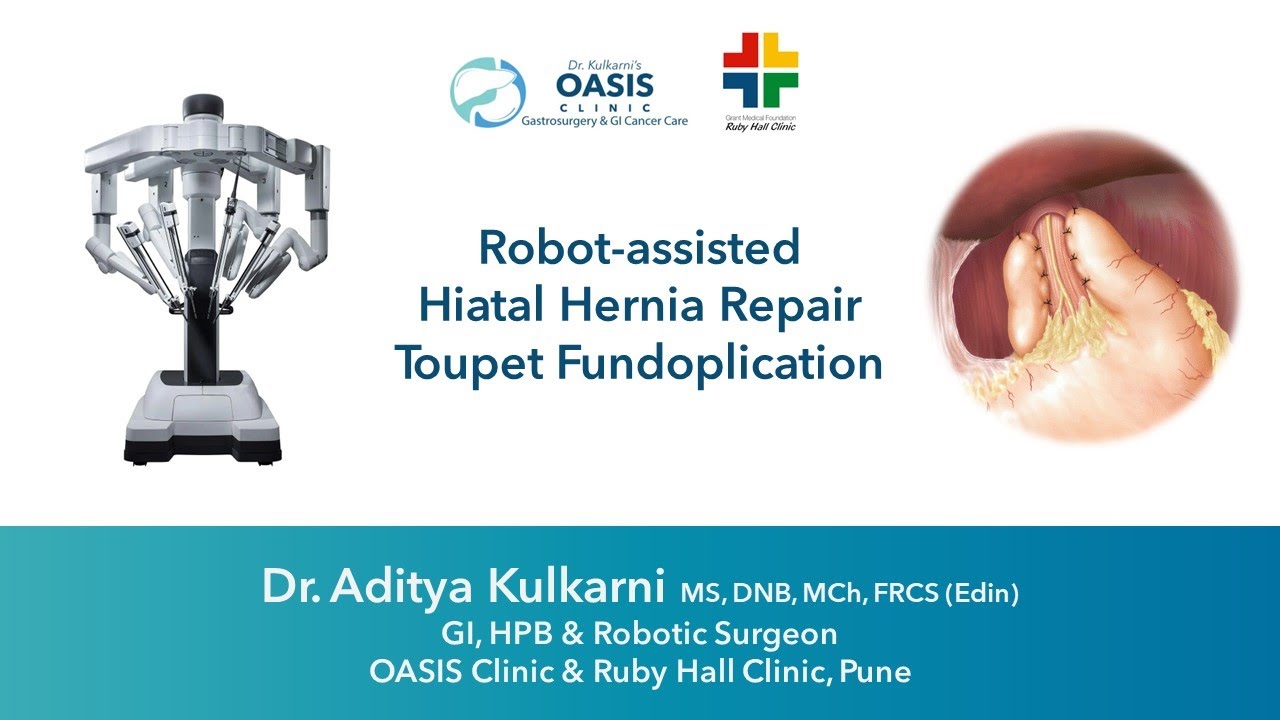 Robotic Hiatal Hernia Repair With Toupet Fundoplication Dr Aditya