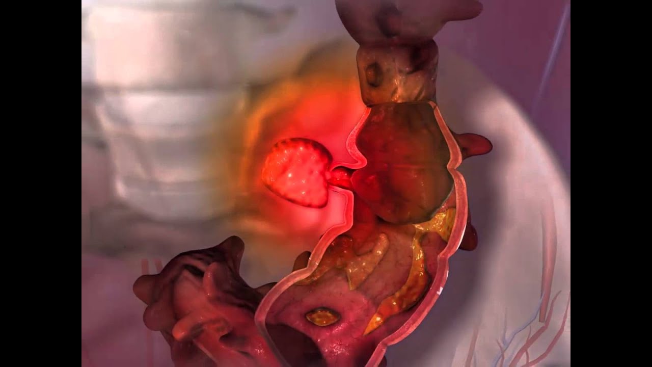 Diverticulitis Learn Visible Body Youtube