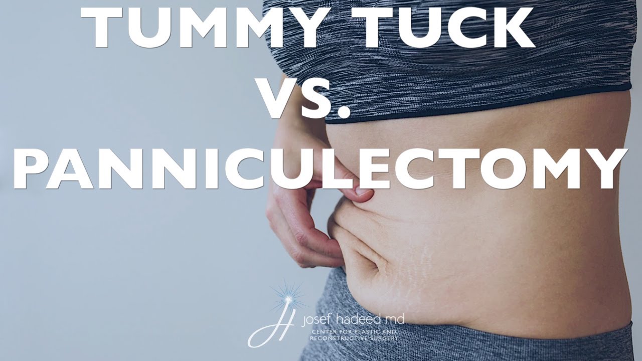 Tummy Tuck Vs Panniculectomy Youtube