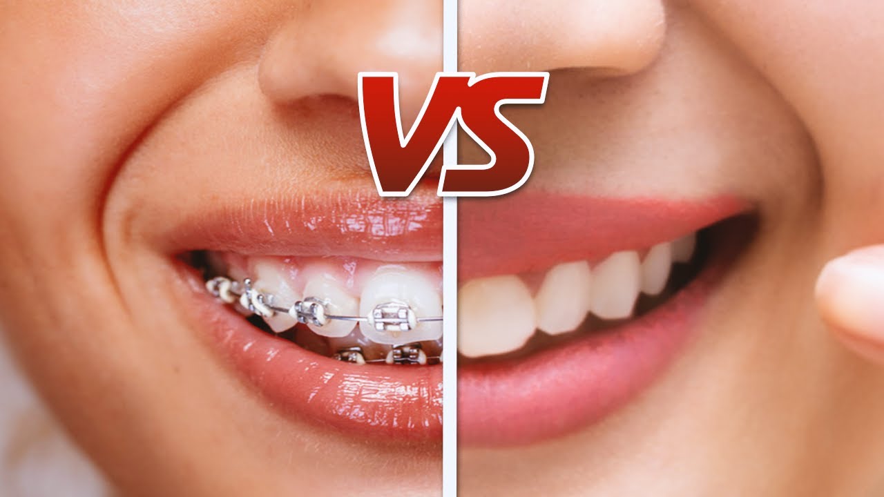 Compare Cost Of Invisalign Regular Braces Kumra 53 Off