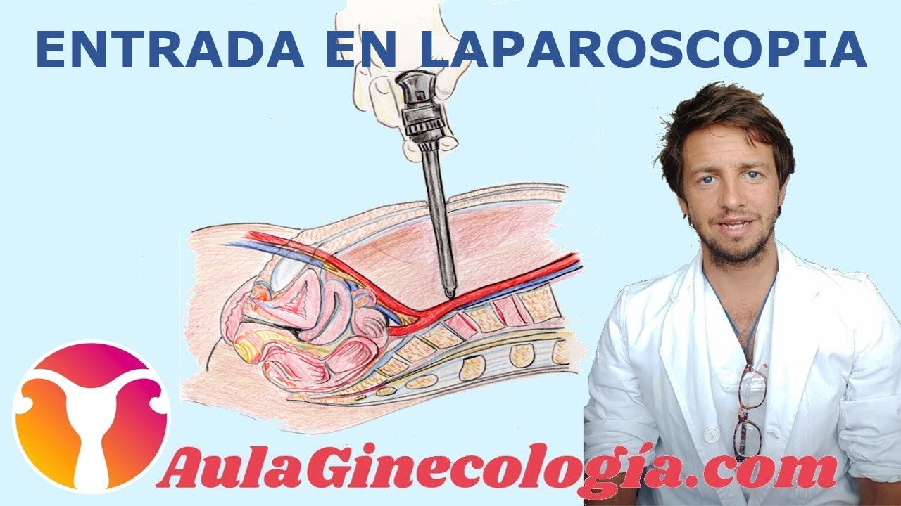 Entrada En Laparoscopia Veress Hasson Directa Trócares Secundarios