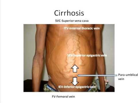 Interpreting Abdominal Wall Veins Youtube