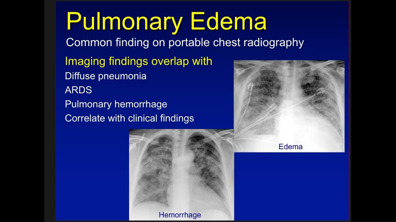 Chest X Ray Pulmonary Edema Vs Pneumonia At Beth Meeks Blog