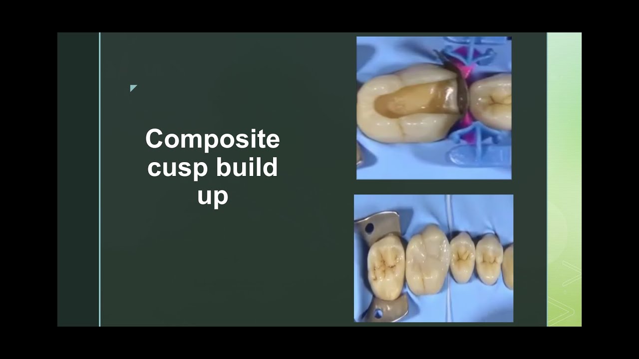 Composite Cusp Build Up Stepbystep Youtube
