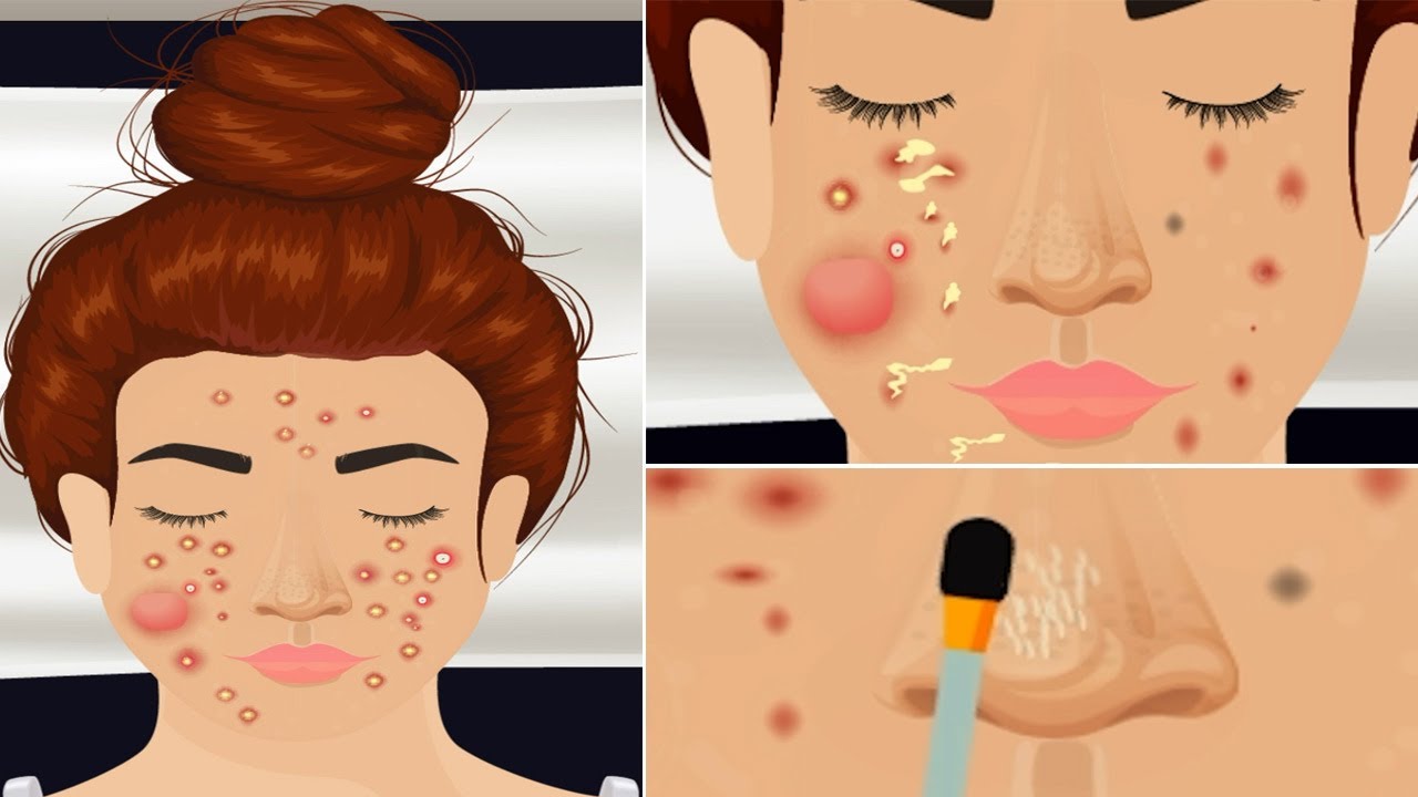 Asmr Acne Removal Skin Care Blackhead Treatment Youtube