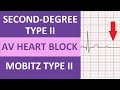 Second Degree Type I Av Heart Block Nursing Nclex Ecg Mobitz Type 1 ...