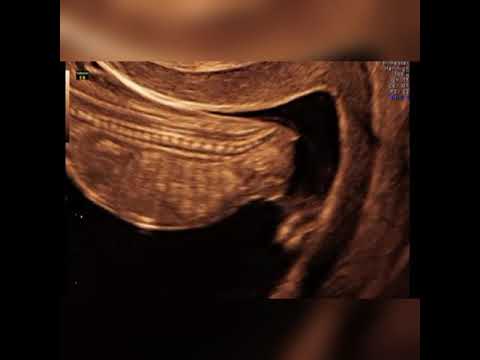 Very Rare Rudimentary Human Fetal Tail By Ultrasound Youtube