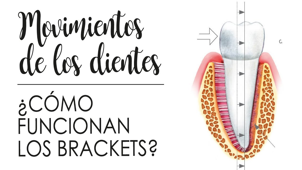 Cómo Funcionan Los Brackets Así Se Mueven Tus Dientes Youtube